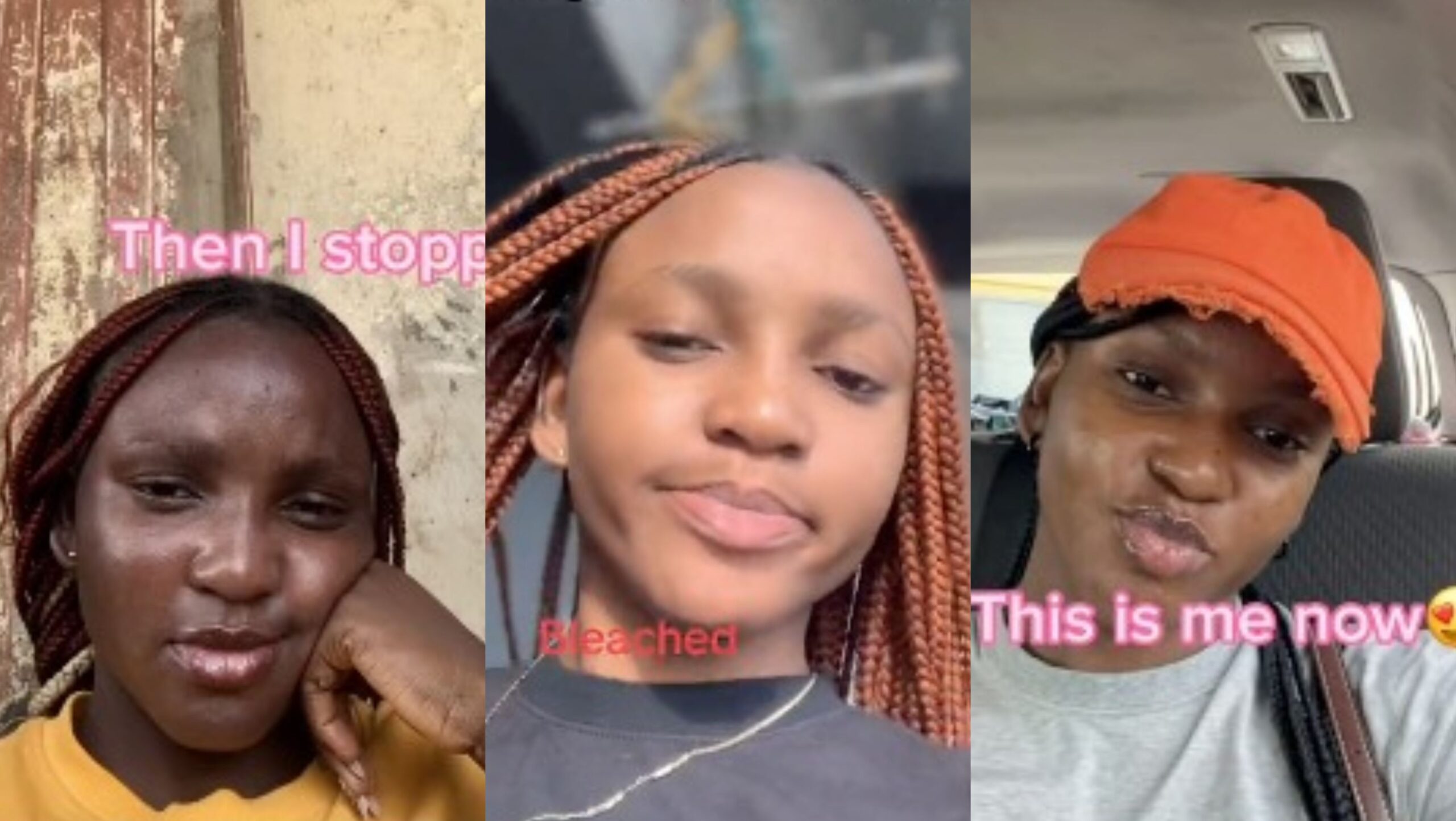 I started having dark knuckles- Lady who bleached her skin shows before ...