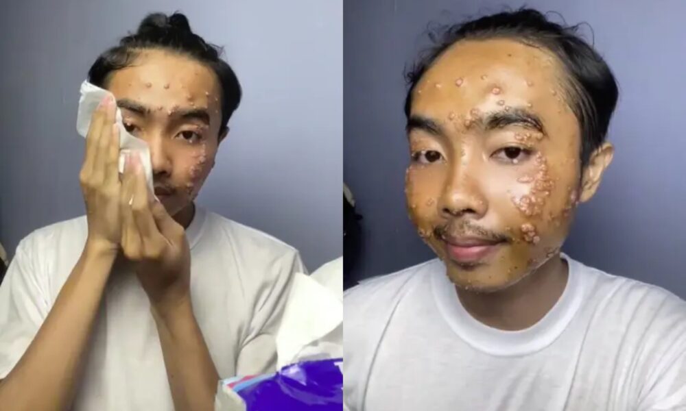 Man’s Face Gets Damaged After Wearing Unwashed Thrift Clothes ...