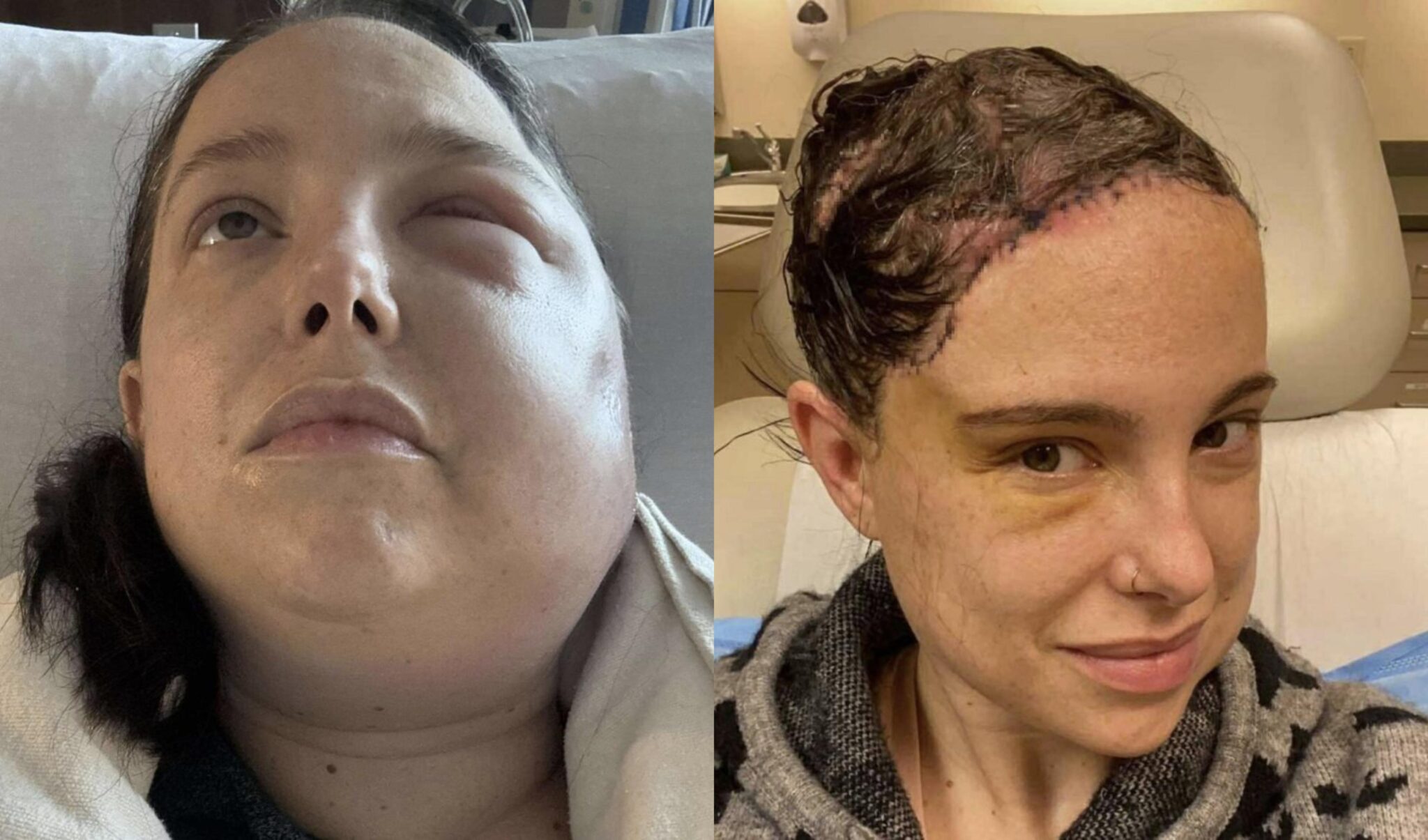 Mom Discovers She Has Cancer After A Small Mole On Her Head Leaves Her ...